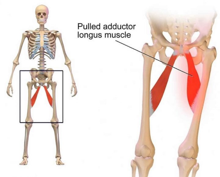 Injury to Adductor Muscles