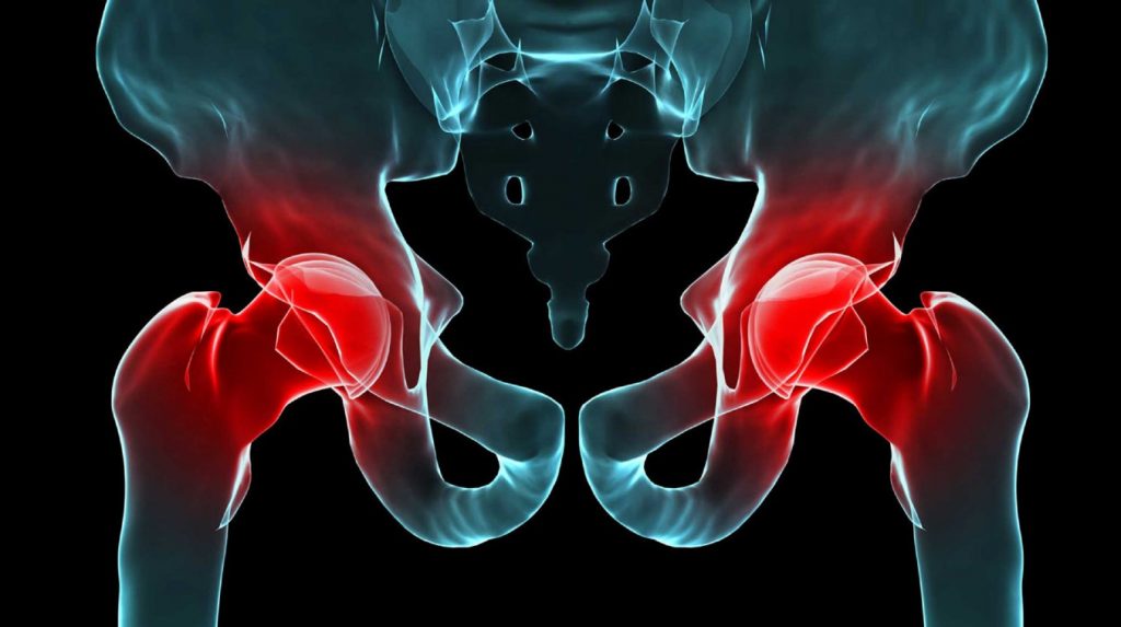 Trochanteric Bursitis Injury